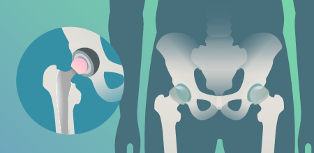 Vervangen informatiedossiers heup- en knieprotheses - Indiveo