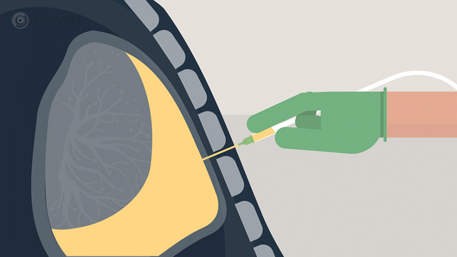 Histologisch biopt - Indiveo