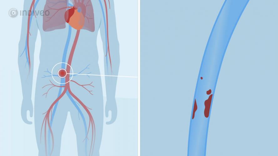 Longembolie - Indiveo