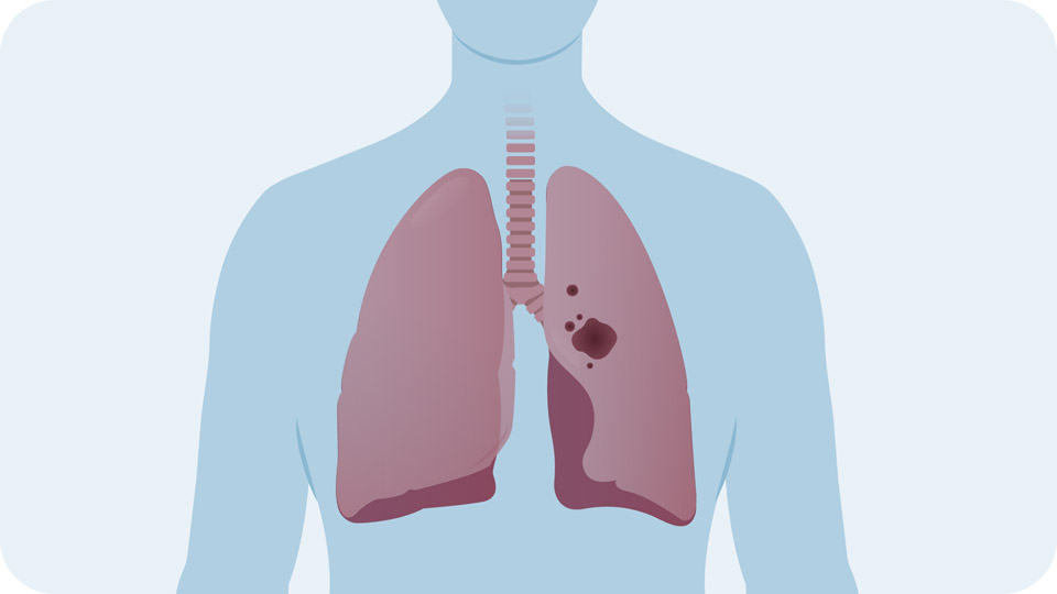 Borstkanker - Indiveo