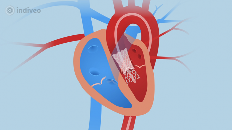 TAVI (Transfemoraal) - Indiveo
