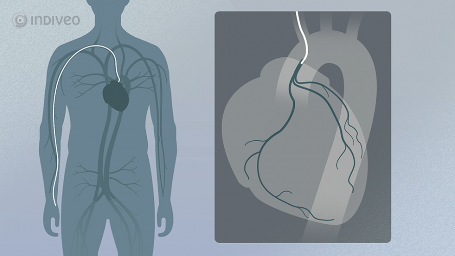 Hartkatheterisatie (CAG) - Indiveo