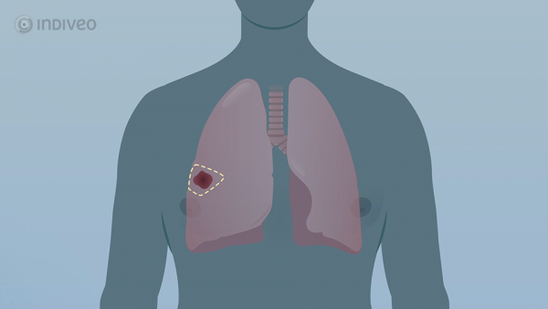 Longoperatie - Indiveo