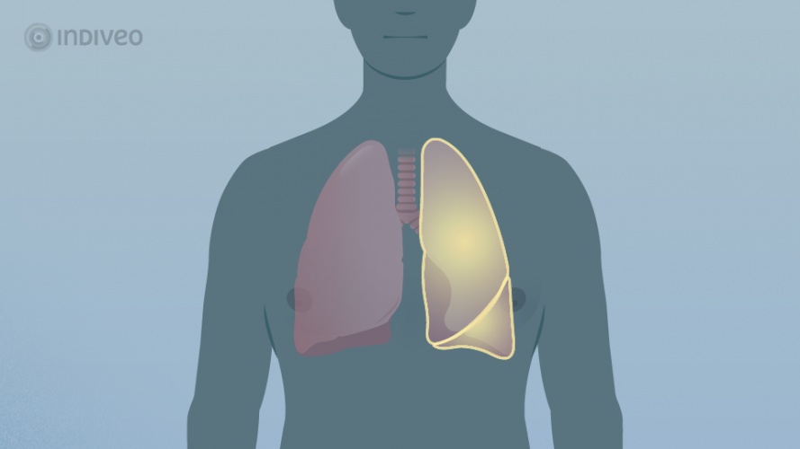 Longziekten - Indiveo