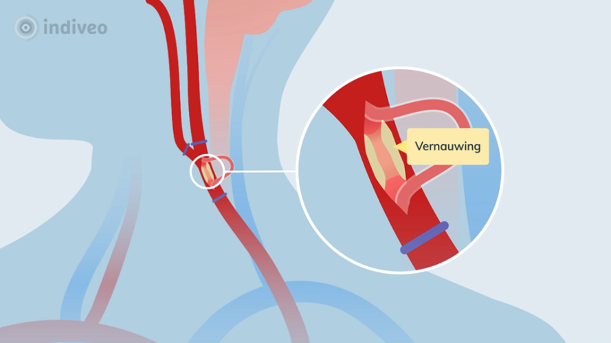 Operatie bij een vernauwde halsslagader (Carotisdesobstructie) - Indiveo