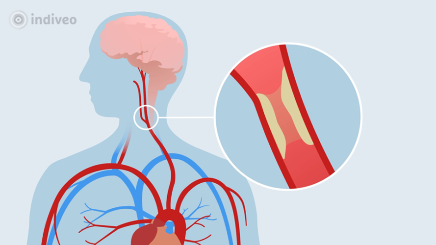 Operatie bij een vernauwde halsslagader (Carotisdesobstructie) - Indiveo