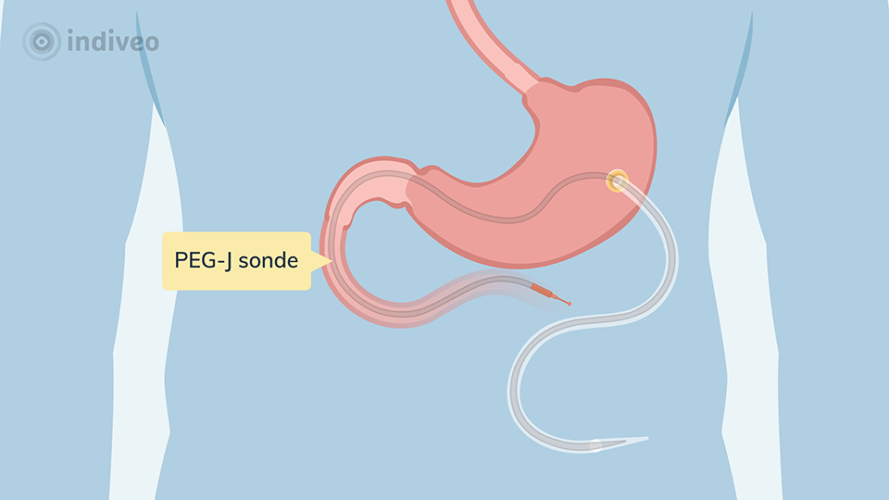 Plaatsing van een PEG- of PEG J-sonde - Indiveo