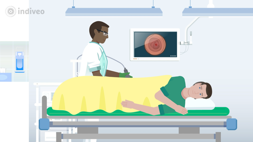 Poliepen in de dikke darm - Indiveo