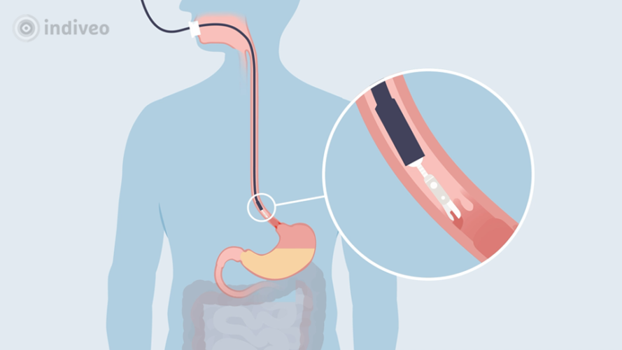 Barrett-slokdarm (Barrett oesophagus) - Indiveo