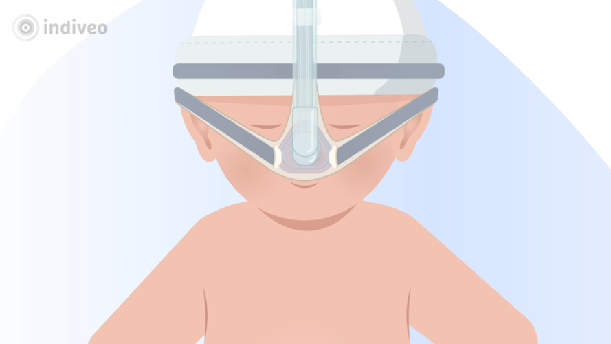 Ademhalingsondersteuning bij pasgeborenen - Indiveo