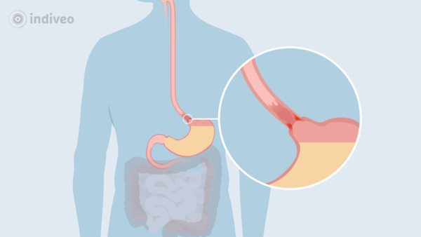 Barrett-slokdarm (Barrett oesophagus) - Indiveo