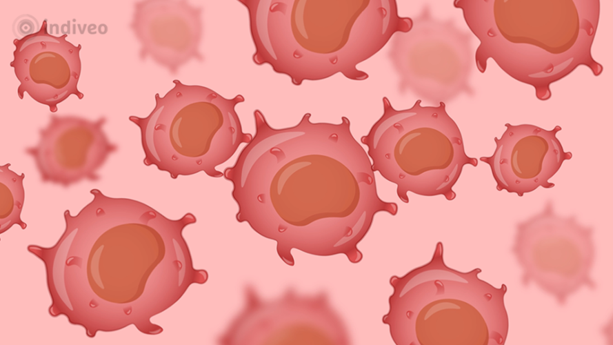 Chronische Lymfatische Leukemie - Indiveo