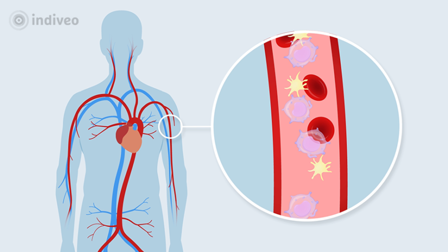 Chronische Lymfatische Leukemie - Indiveo