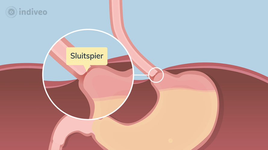 Fundoplicatie - Indiveo