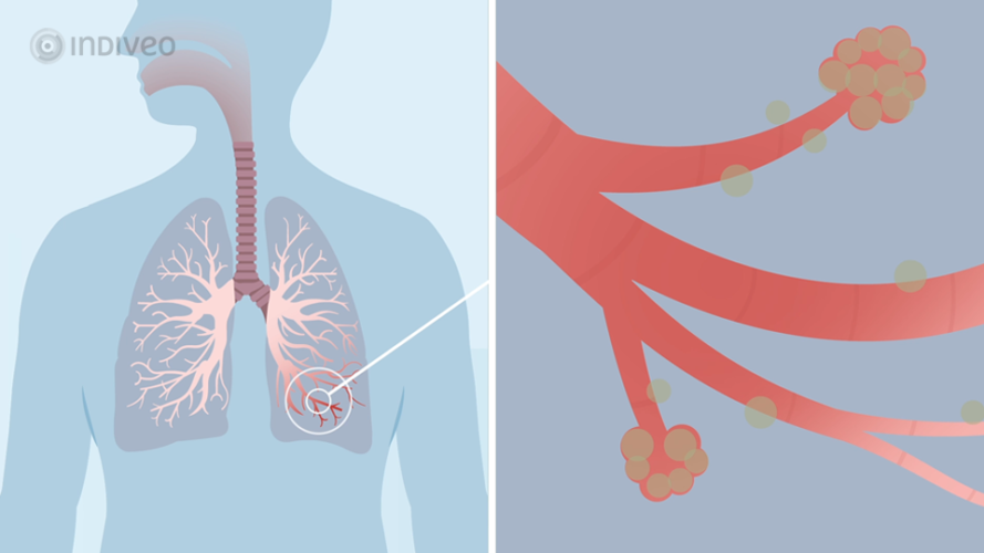 Longontsteking - Indiveo