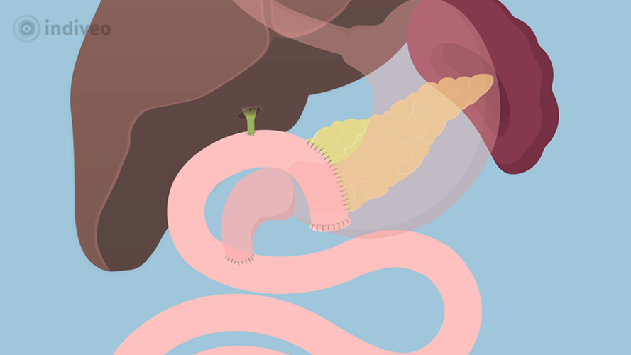 Operatie aan de alvleesklier (PPPD en Whipple) - Indiveo