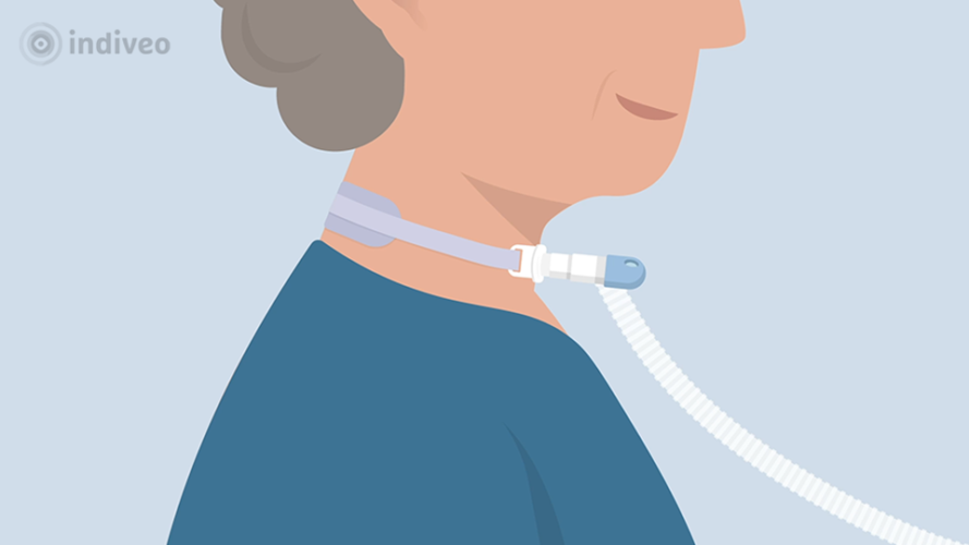 Airvo bij tracheacanule en tracheostoma - Indiveo